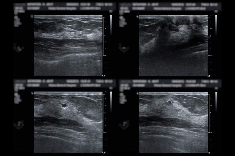 Breast Imaging - Mammograms | Breast MRI, Ultrasound & Biopsies in Fort ...