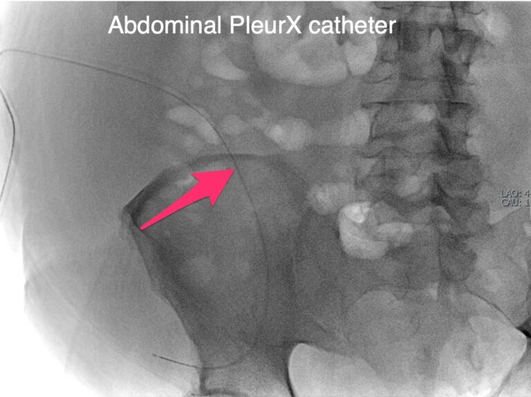 Chest & Abdomen Pleurx Catheters | At-Home Fluid Management