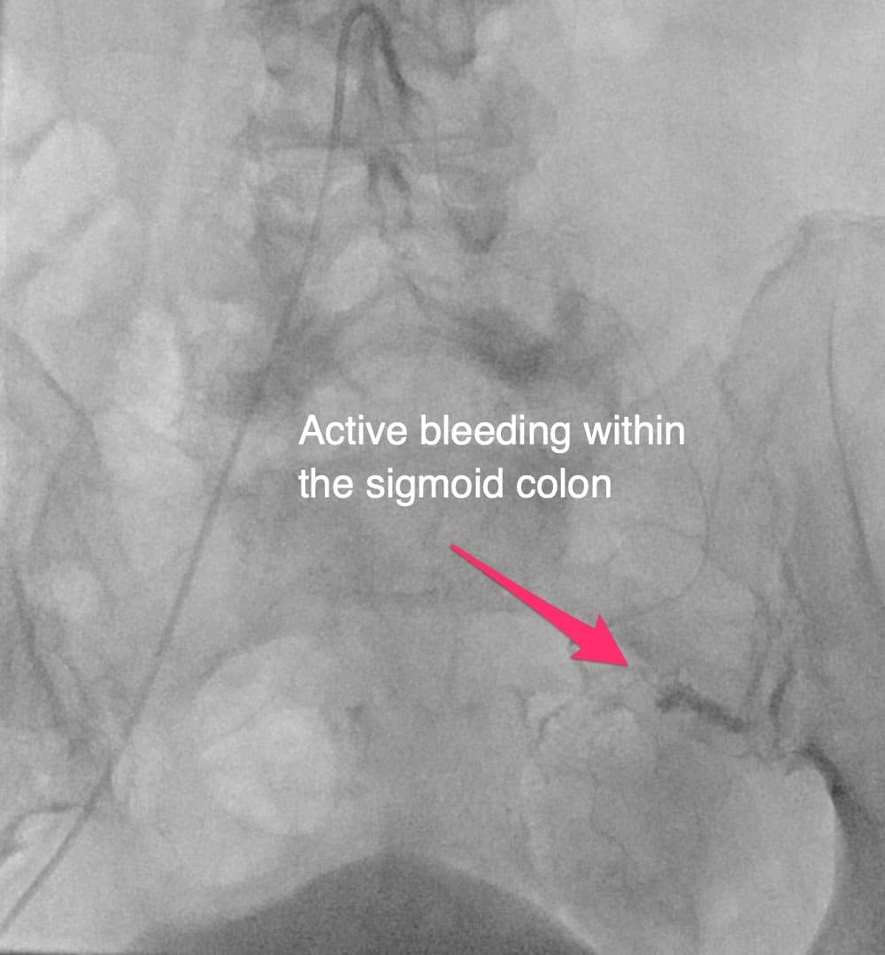 Angiography and Embolization: Targeted Bleeding Control