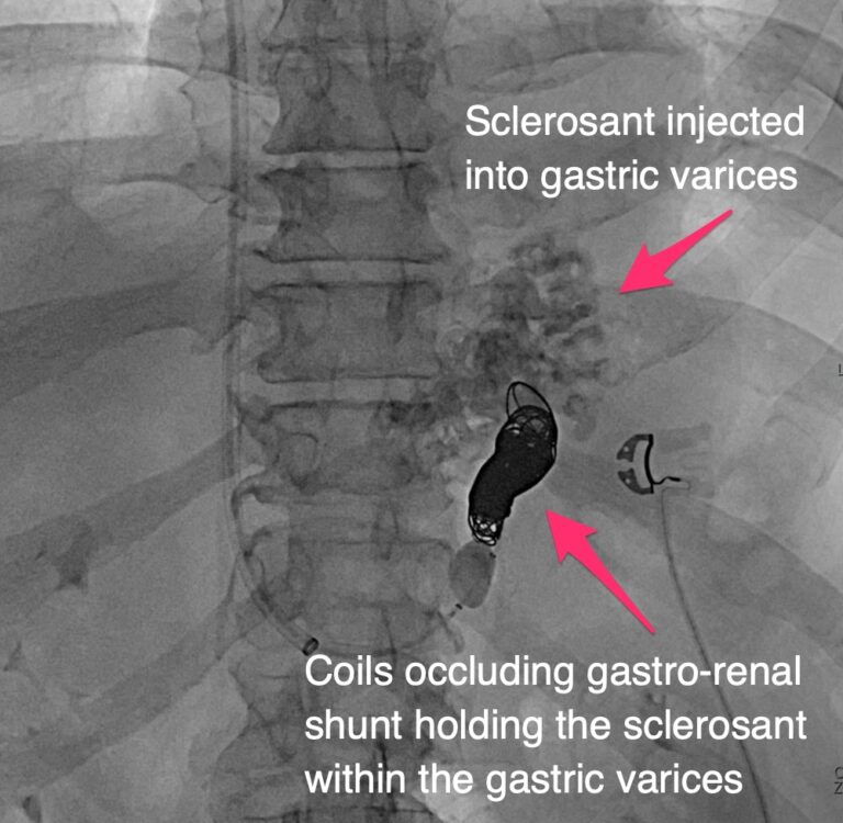 BRTO & BATO Procedures | Treating Gastric Varices and Portal Hypertension