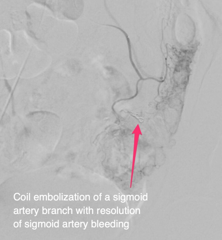 Angiography and Embolization: Targeted Bleeding Control