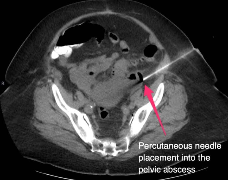 Drainage Catheters | Minimally Invasive Fluid & Abscess Relief