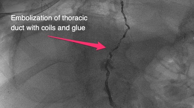 Thoracic Duct Embolization: Minimally Invasive Chylothorax Relief