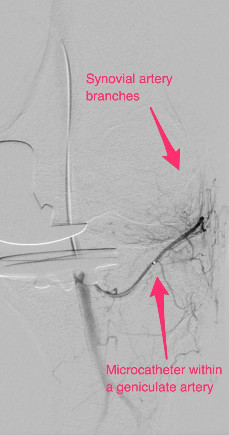 Genicular Artery Embolization | Non-Surgical Relief for Knee Pain