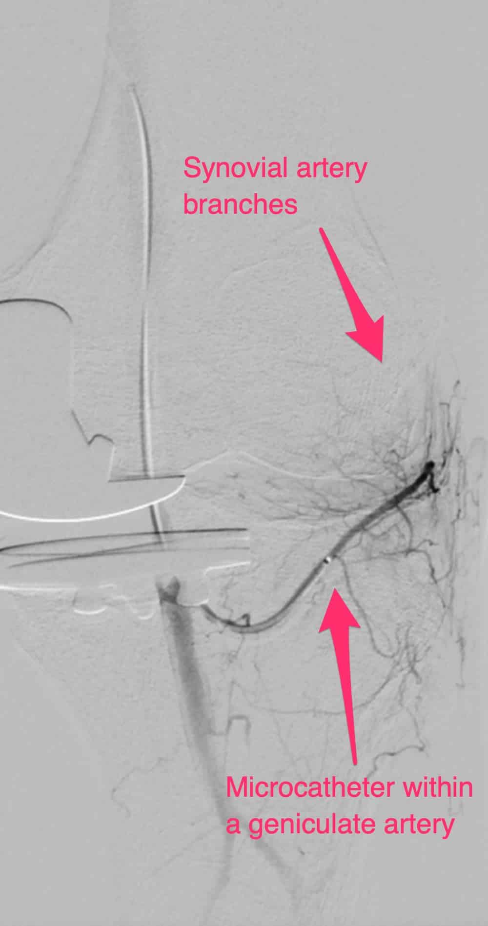 Genicular Artery Embolization | Non-Surgical Relief for Knee Pain