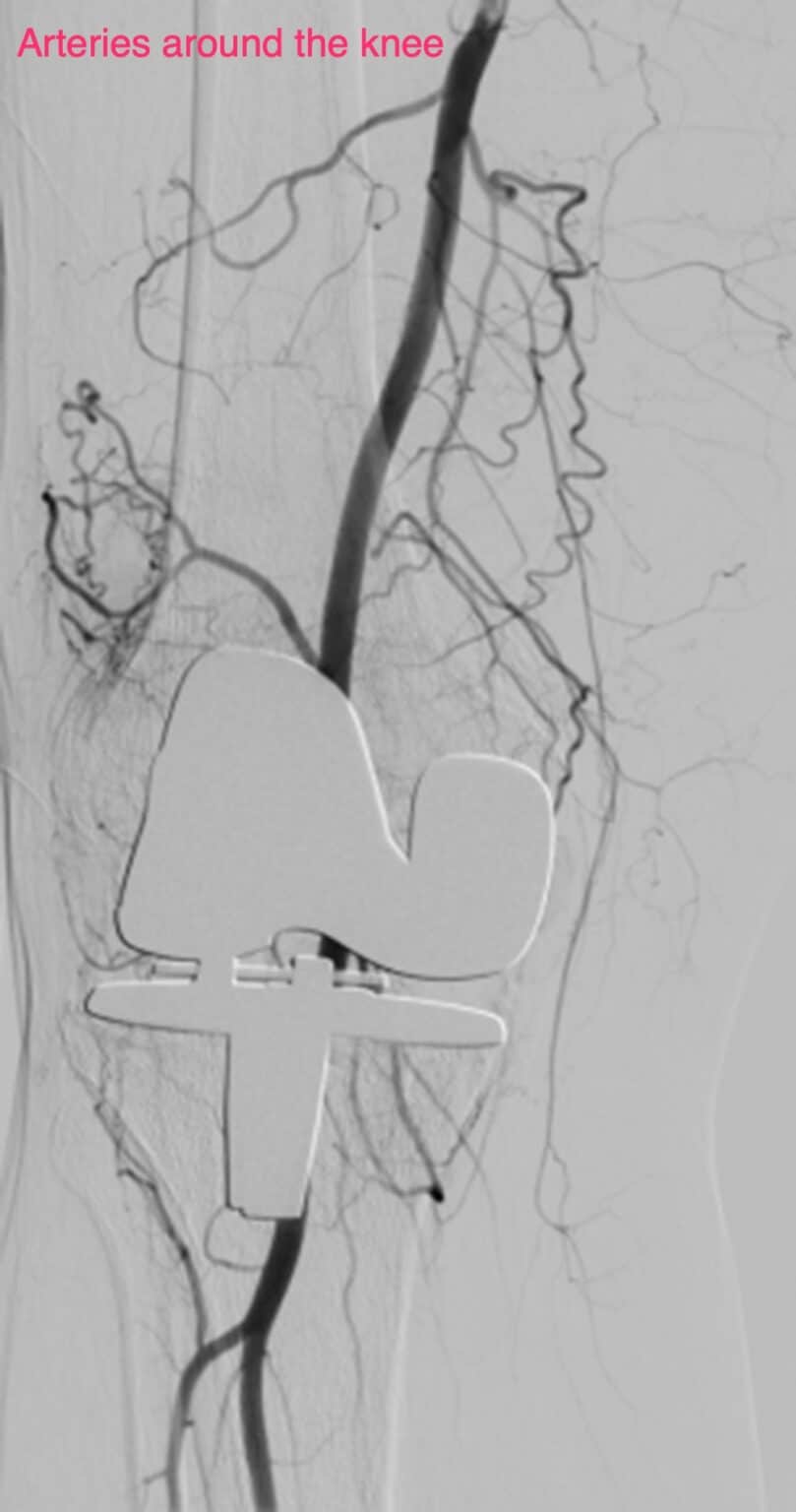 Genicular Artery Embolization | Non-Surgical Relief for Knee Pain