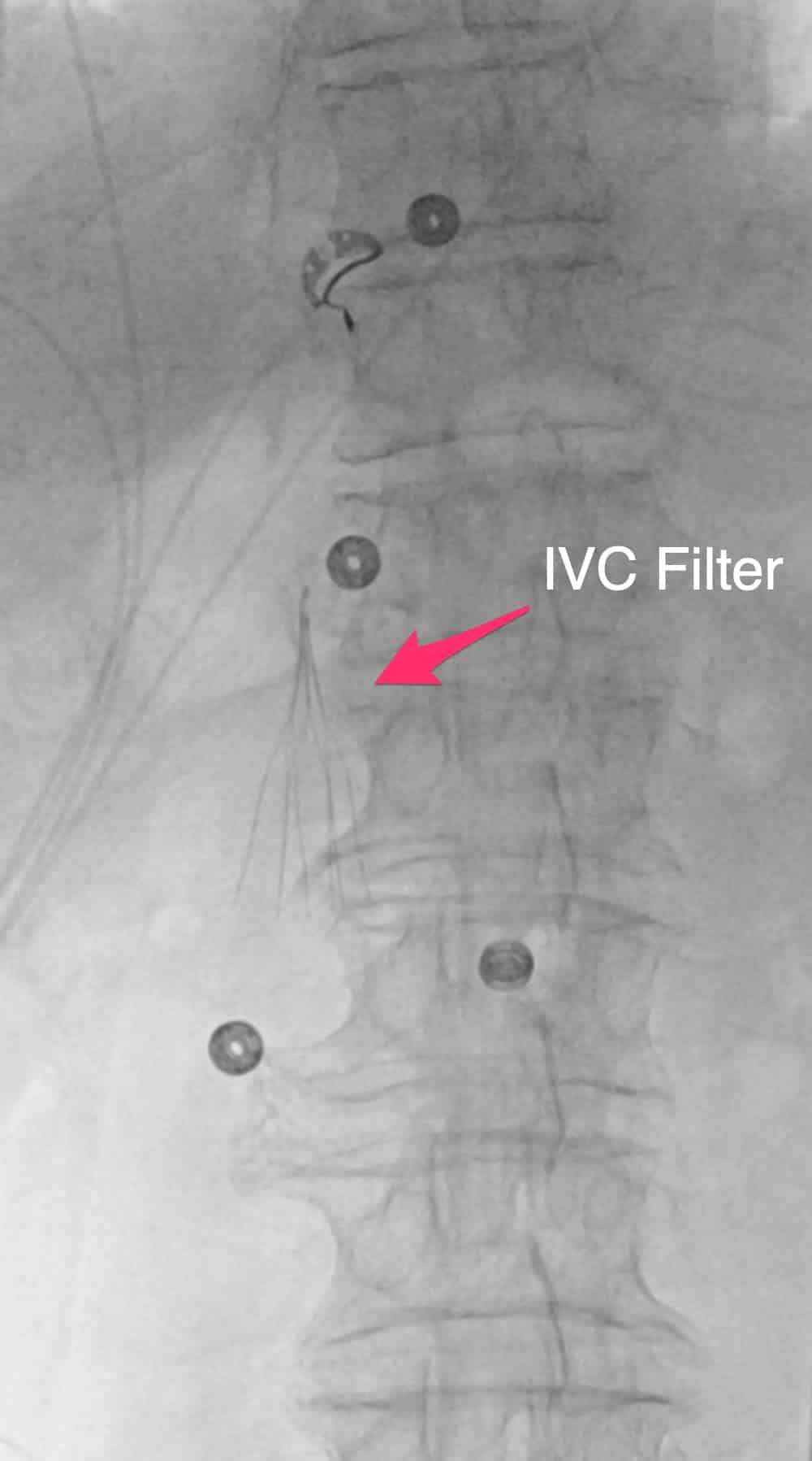 IVC Filter Placement and Removal | Blood Clot Prevention IVC Filter Placement and Removal | Blood Clot Prevention