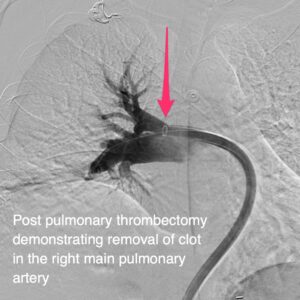 Pulmonary Artery Thrombectomy and Thrombolysis | PE Treatment