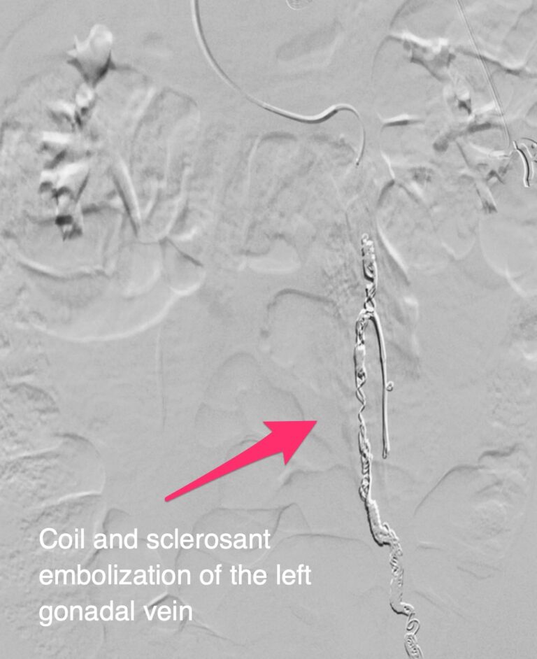 Varicocele Embolization | Minimally Invasive Treatment for Varicoceles
