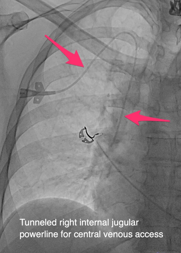 Image-Guided Venous Access Placement | PICC Lines, Ports & Dialysis ...