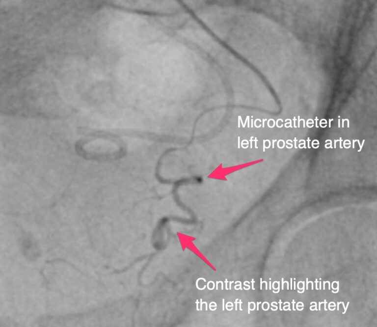 Prostate Artery Embolization | Treatment for Enlarged Prostate Symptoms