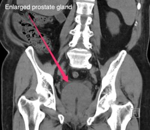 Prostate Artery Embolization | Treatment for Enlarged Prostate Symptoms