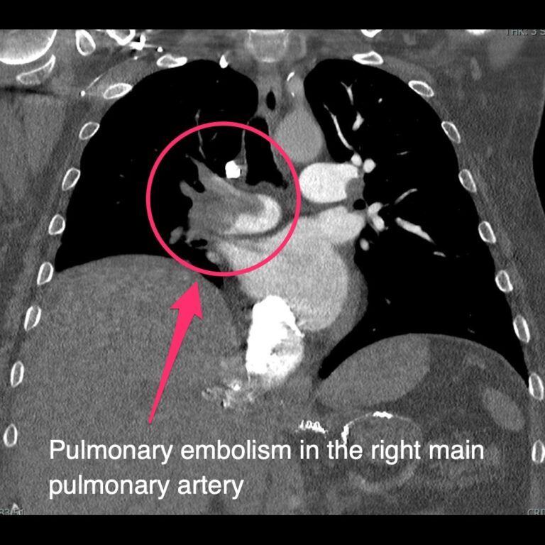 Pulmonary Artery Thrombectomy and Thrombolysis | PE Treatment