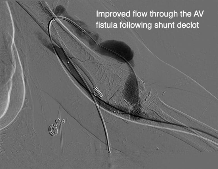Renal Grafts and AV Fistula Evaluation and Declot | Dialysis Access Care