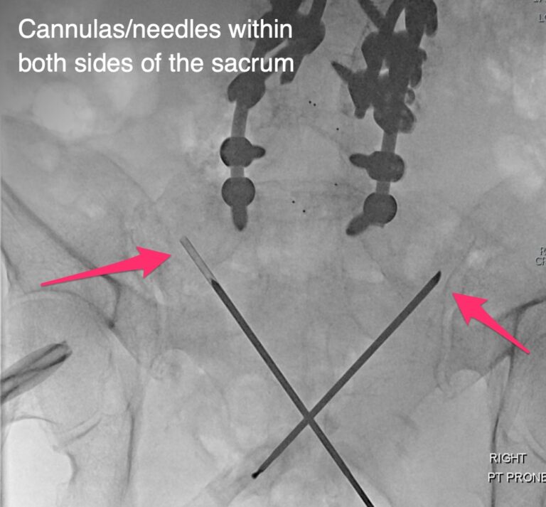 Image-Guided Sacroplasty | Relief for Painful Sacral Fractures
