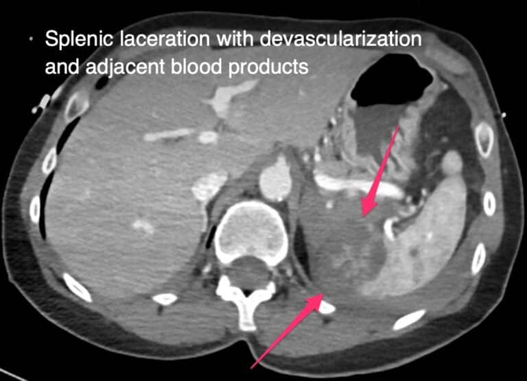 Angiography and Embolization: Targeted Bleeding Control