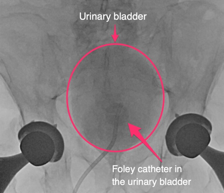 Suprapubic Catheter Placement for Bladder Obstruction Relief