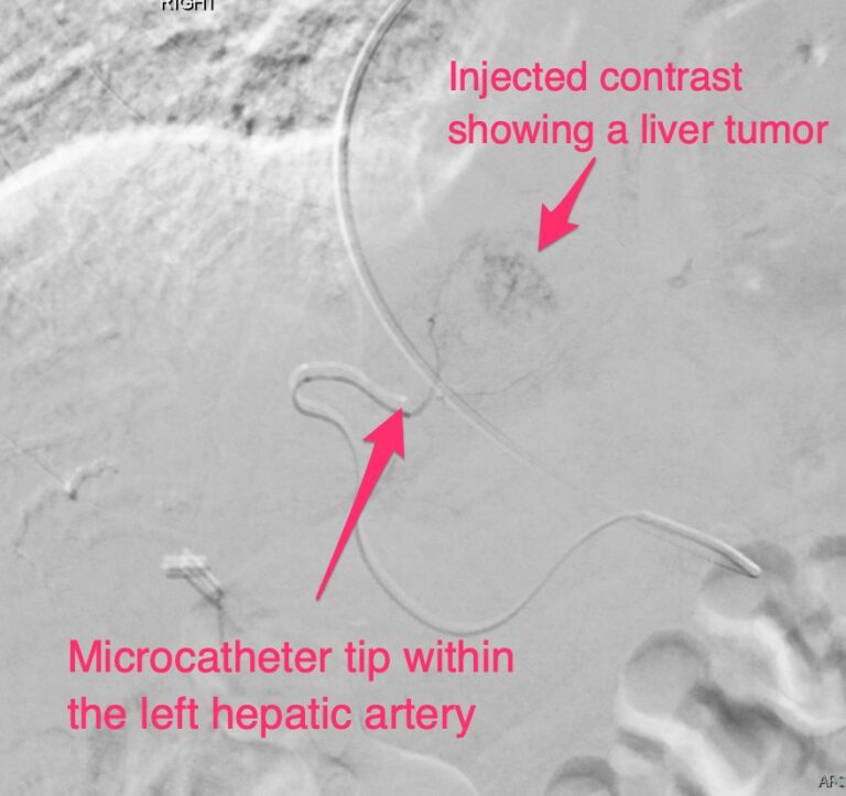 Transarterial Chemoembolization (TACE) | Liver Tumor Treatment | Interventional Radiology