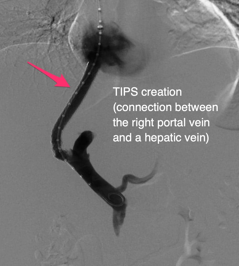 TIPS - Transjugular Intrahepatic Portosystemic Shunt for Liver Disease