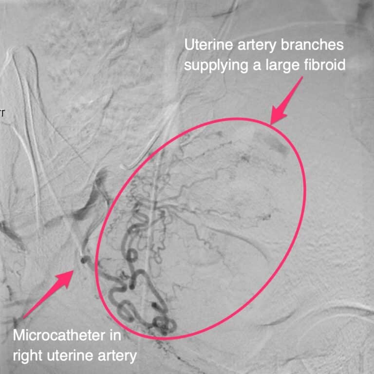 Uterine Artery Embolization | Minimally Invasive Treatment for Fibroids