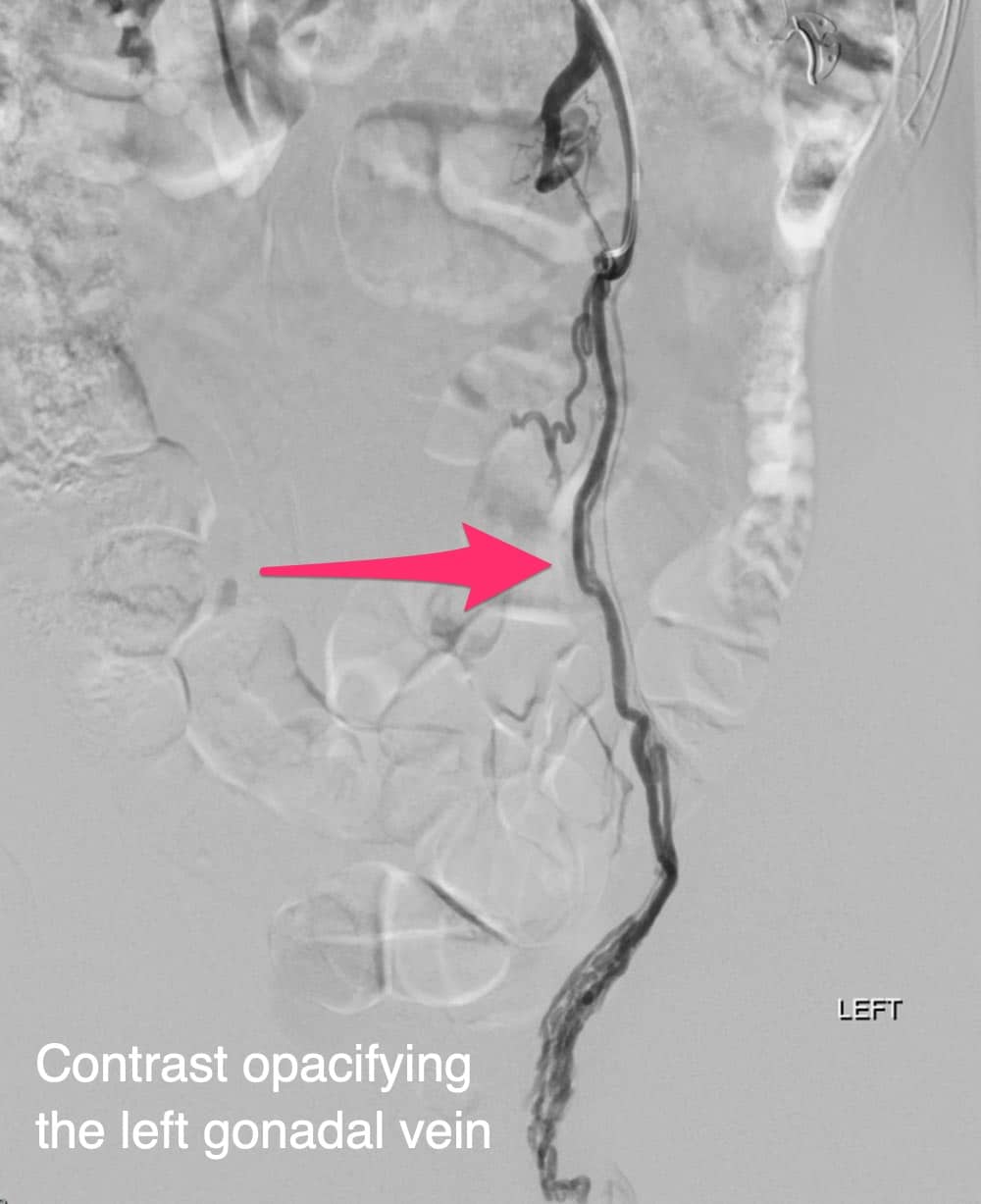 Varicocele Embolization | Minimally Invasive Treatment for Varicoceles