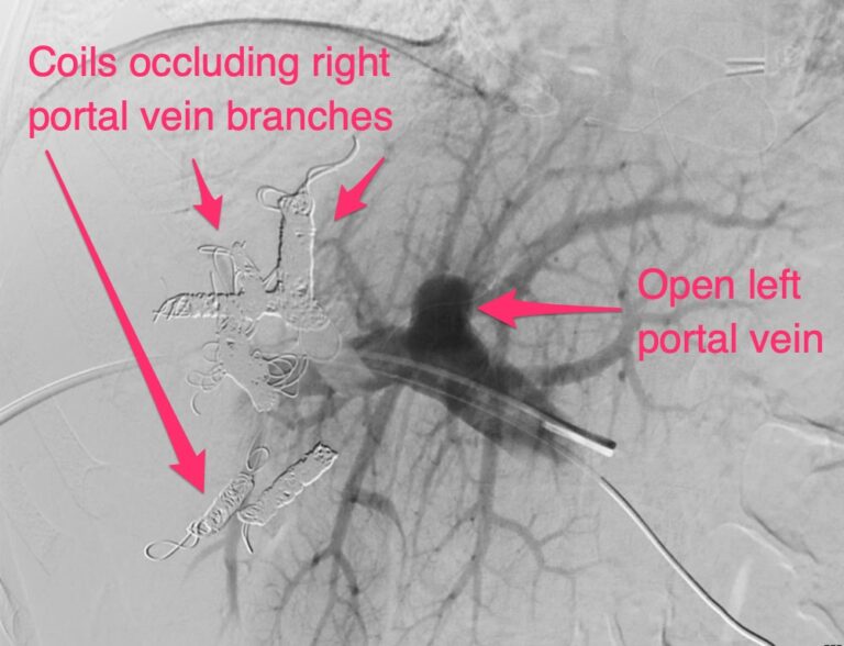 Portal Vein Embolization | Advanced Liver Tumor Treatment Technique
