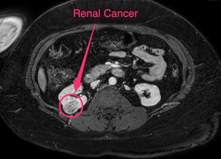 Renal Tumor Treatment | Embolization for Kidney Tumors - Interventional ...