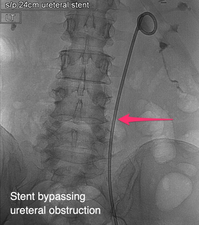 Nephrostomy Tubes & Ureteral Stents | Kidney Obstruction Relief